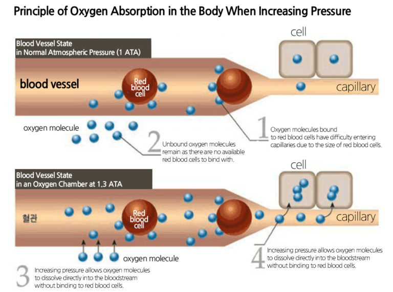 Buy Hyperbaric Oxygen Chamber- Certified HBOT Device for Therapy